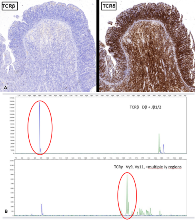 A case report and a literature review about central nervous system ...