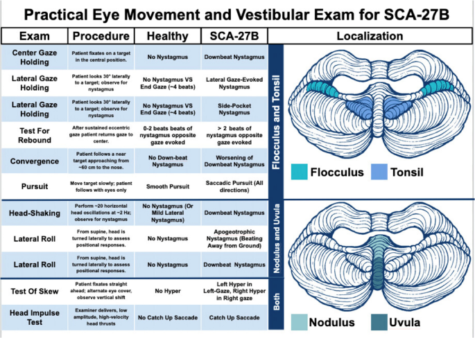 Ocular Motor and Vestibular Profile in Spinocerebellar Ataxia Type 27B ...