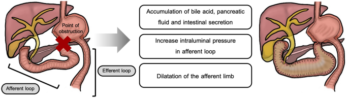 Diagnosis and treatment of the afferent loop syndrome | SpringerLink