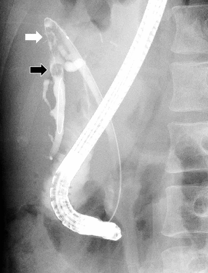 Multiple intraductal papillary neoplasms of bile duct diagnosed based ...