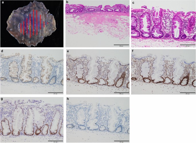 BRAF-mutant mismatch repair deficient invasive colon cancer regressing ...