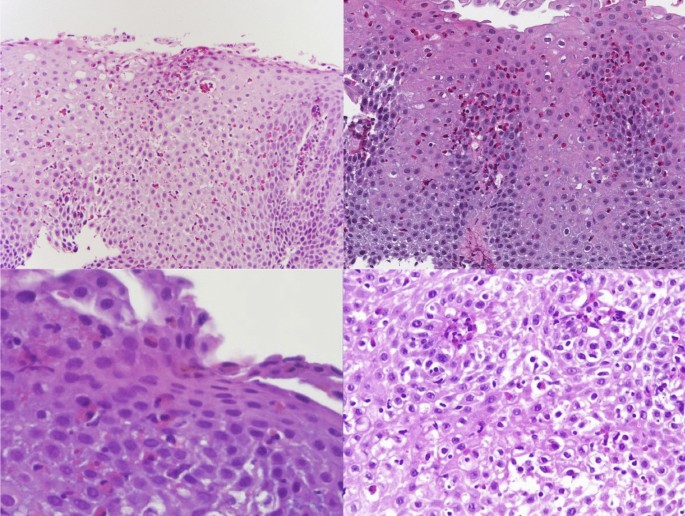 Sustained clinical and histopathological remission in a patient with ...