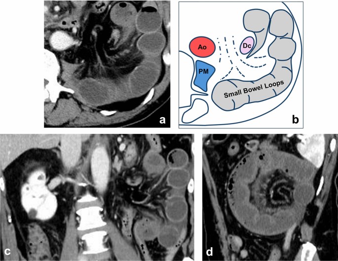 Transmesenteric internal hernia: an unexpected adverse event induced by ...