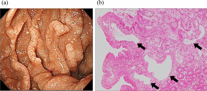 First case report of intestinal lymphangiectasia with refractory ...
