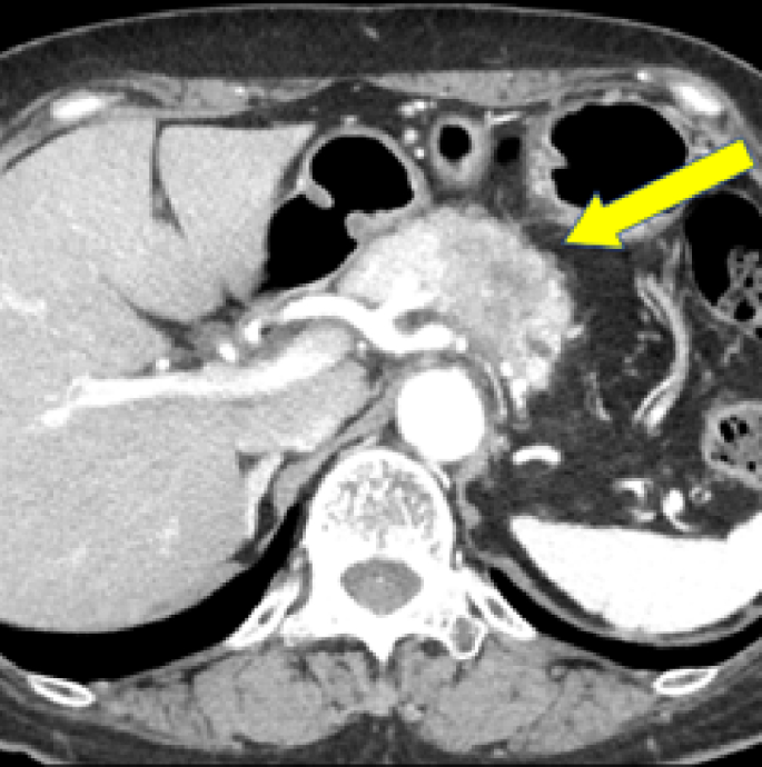A case of MSI-high pancreatic body-tail cancer successfully treated ...