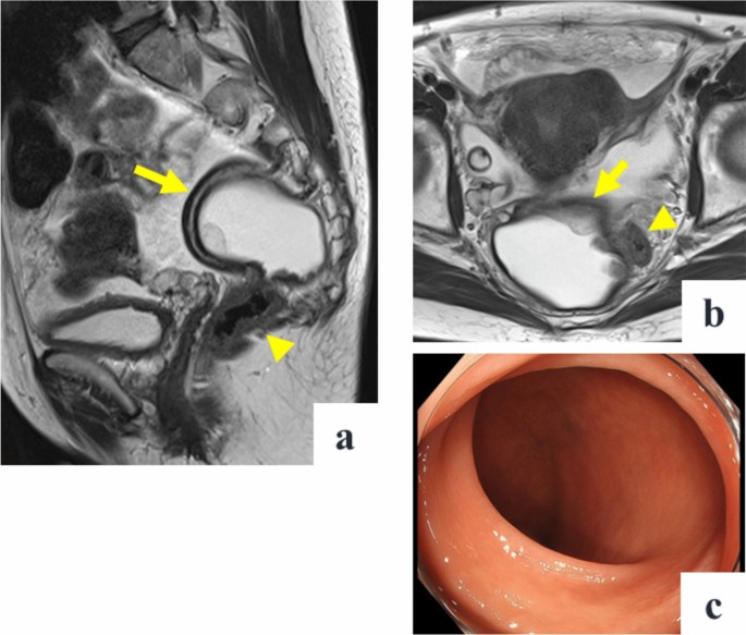A case of deep endometriosis with cyst formation as a differential ...