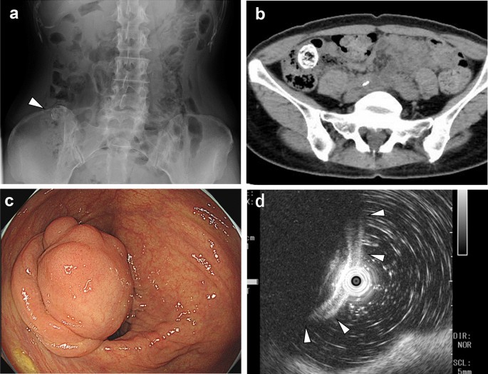 A large non-inverted true diverticulum resembling a submucosal tumor of ...
