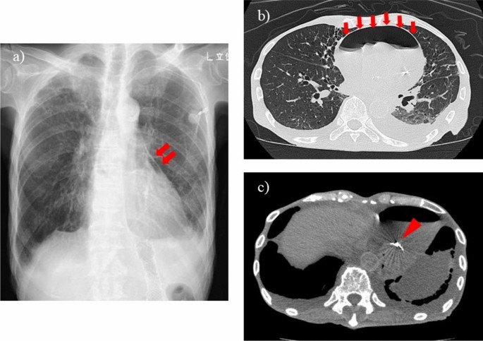 A case of pneumopericardium due to metallic stent placement in the ...