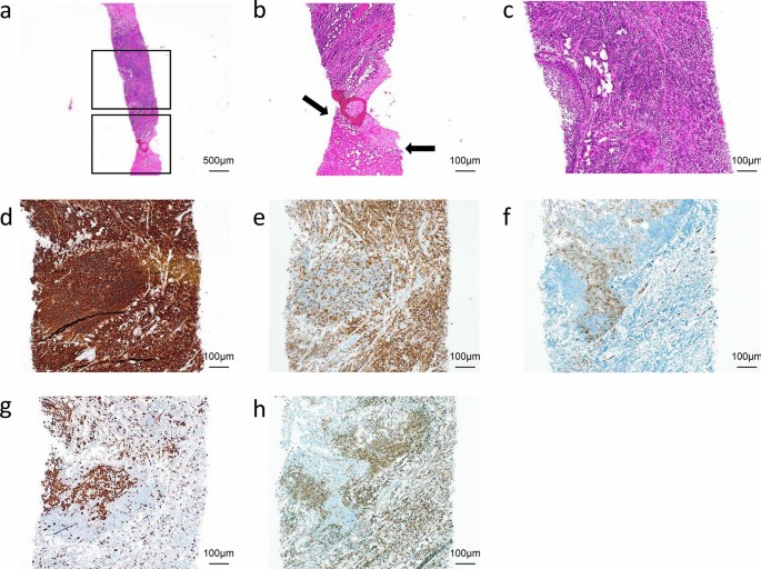Hepatic reactive lymphoid hyperplasia diagnosed through post-ablation ...