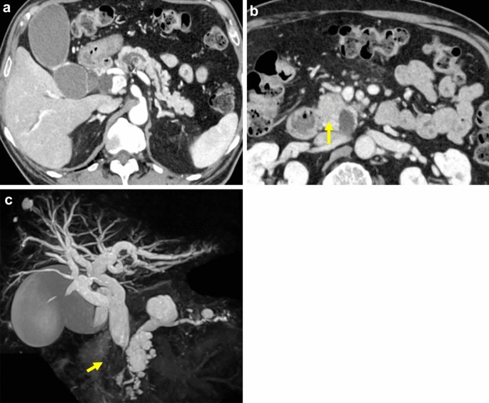 Fecal colitis obliterans and cytomegalovirus enteritis after ...