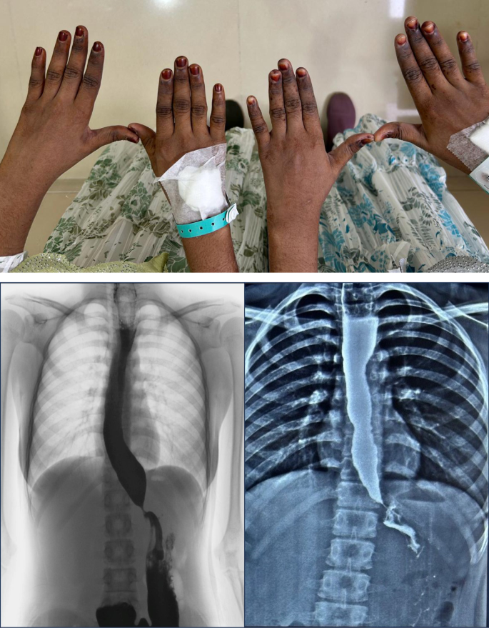 Peroral endoscopic myotomy followed by antireflux mucosectomy for ...