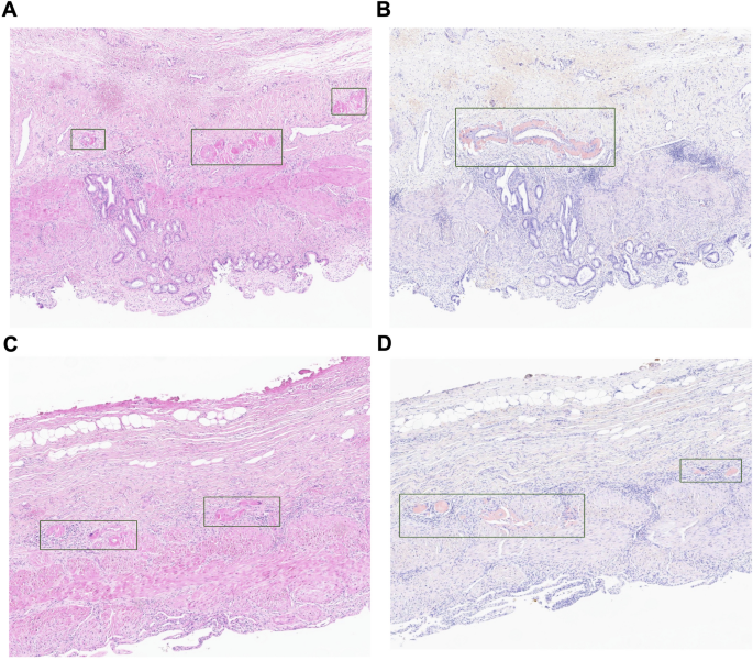 A rare cause of persistent cholestatic jaundice: gallbladder ...