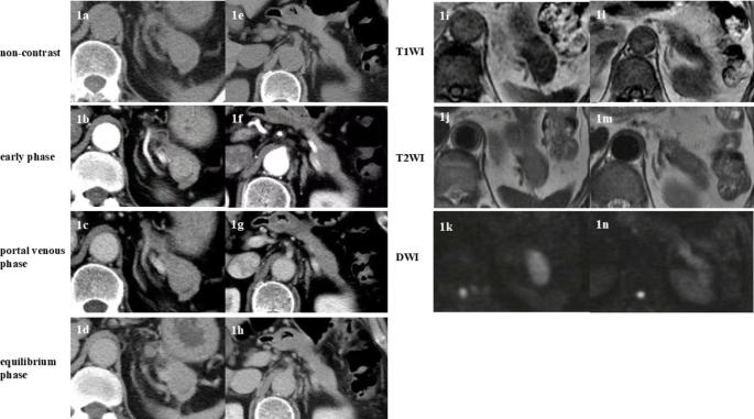 Pancreatic acinar cell carcinoma with characteristic imaging due to ...