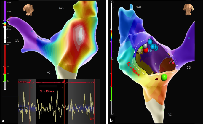 Radiofrequency ablation of supraventricular tachyarrhythmias in ...