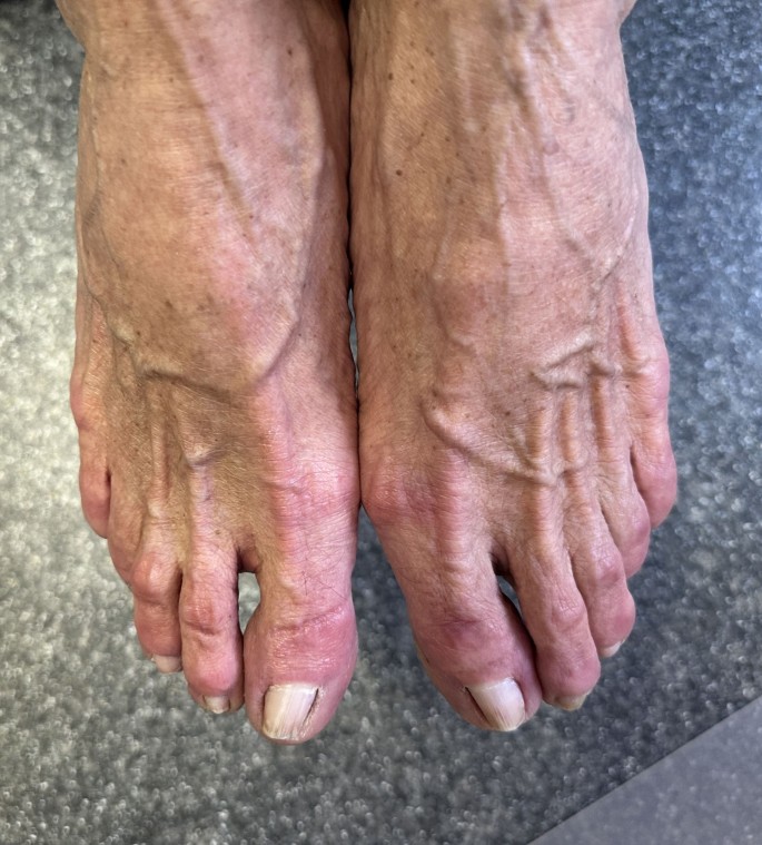 Orthonyxie bij convexe nagels | Voetenwerk | Springer Nature Link
