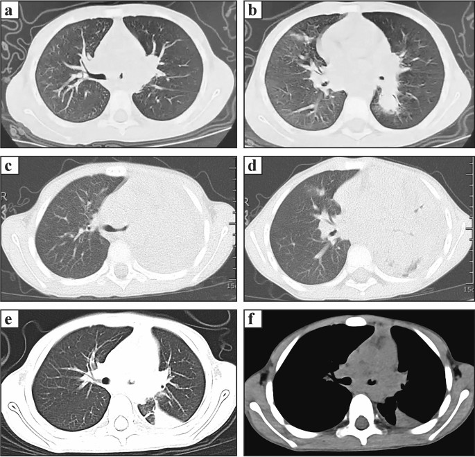Persistent cough with unexplained endobronchial mass | World Journal of ...