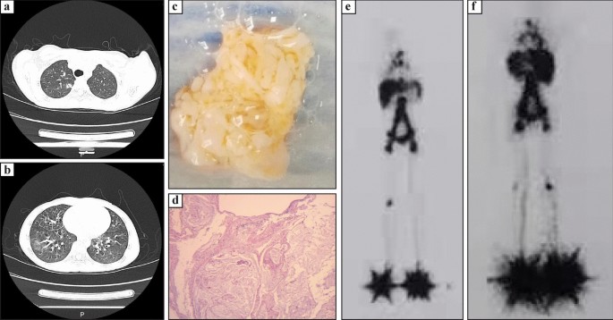 Lymphatic plastic bronchitis | World Journal of Pediatrics | Springer ...
