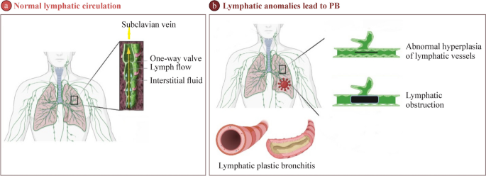 Lymphatic plastic bronchitis | World Journal of Pediatrics | Springer ...