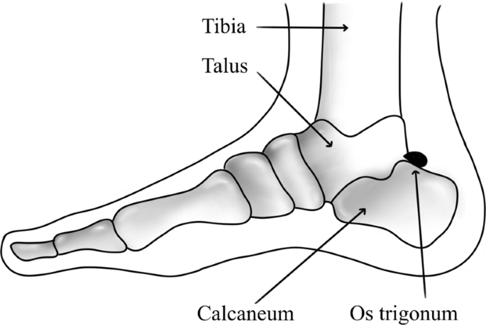 Prevalence and clinical aspects of os trigonum: a meta-analysis ...