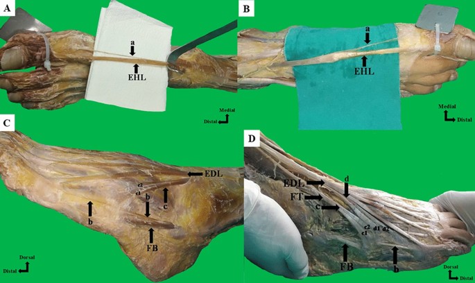 Tendon variations of the fibularis brevis and extensor muscles in leg ...