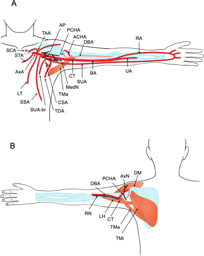 Rare combined variations of the axillary artery: superficial ulnar ...