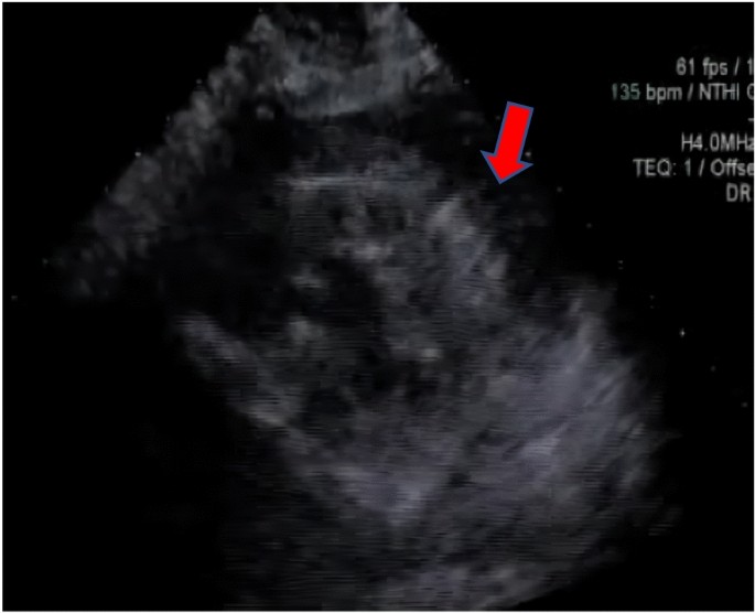 A painless Stanford type A acute aortic dissection and acute heart ...
