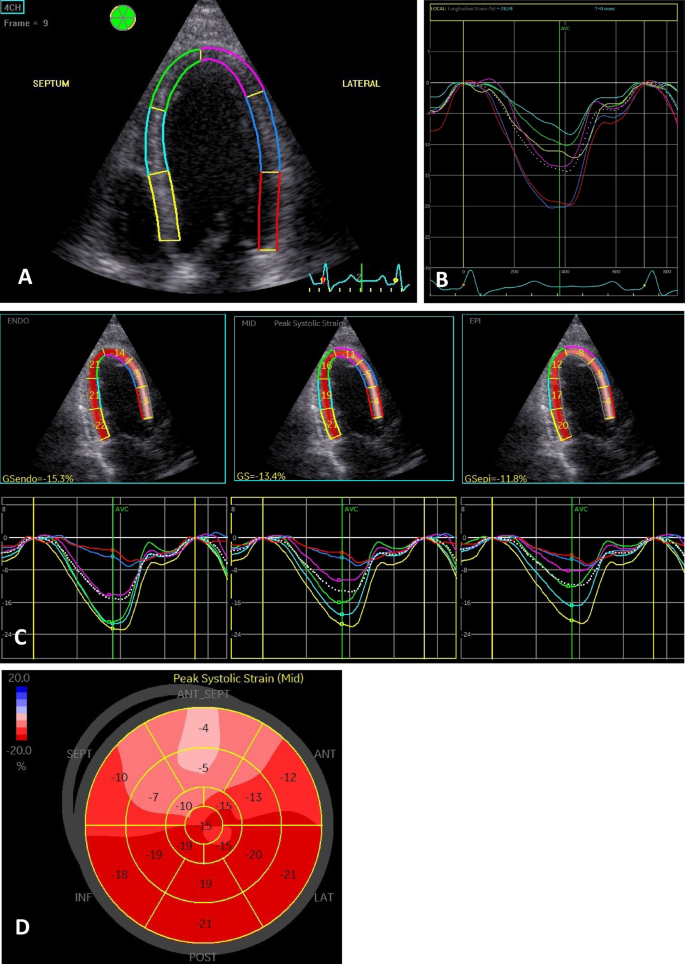 Global, segmental, and layer-specific two-dimensional speckle tracking ...