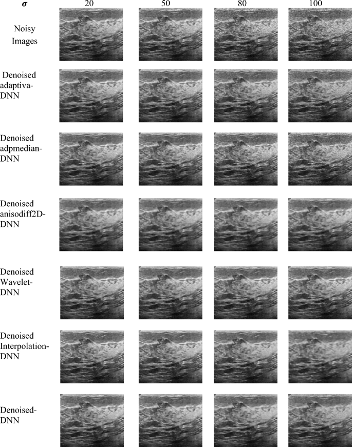 DNN-driven hybrid denoising: advancements in speckle noise reduction ...