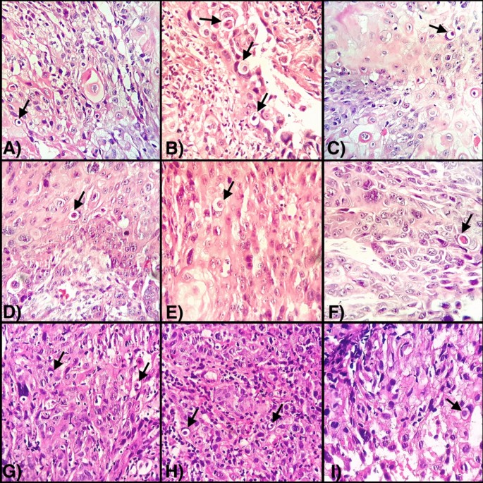Association of Cellular Cannibalism with Immunohistochemical Expression ...