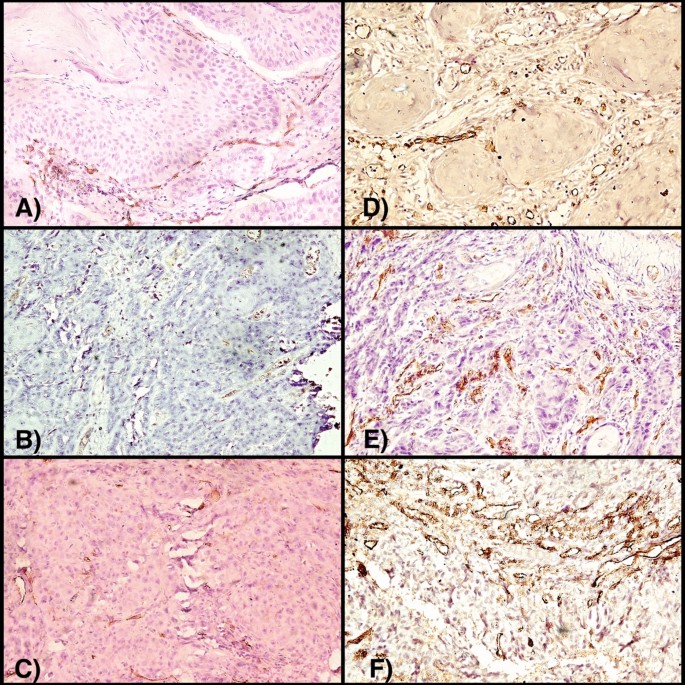 Association of Cellular Cannibalism with Immunohistochemical Expression ...