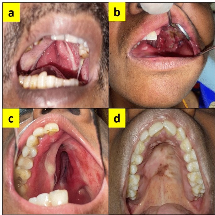 Exercise Caution with Palatal Swelling: A Case Series on Minor Salivary ...