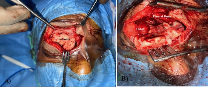 Giant Osteoma of the Frontal Recess Presenting As Proptosis | Journal ...