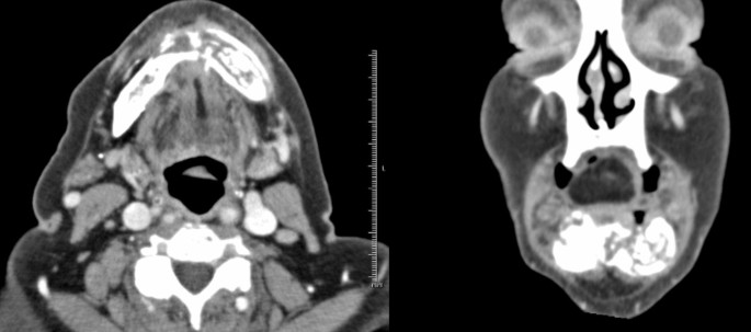 Carcinoma Cuniculatum, a Rare Variant of Oral Squamous Cell Carcinoma ...