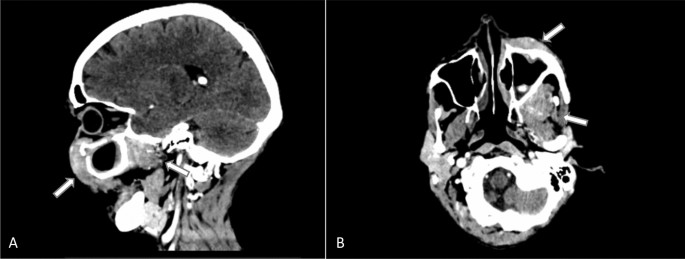 Odd Ball Paradigms of Rhino Facial Swellings: A Diagnostic Dilemma of ...