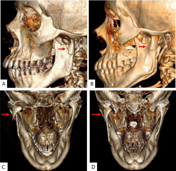 Non-Invasive Management of Mandibular Condyle Fracture with Ramus ...