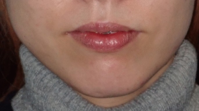 Triangle-Shifting Genioplasty with Bone Graft to Correct Chin Asymmetry ...