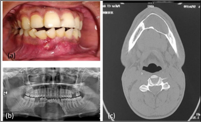 Rare Occurrence of Epidermoid Inclusion Cyst in the Mandible: A ...