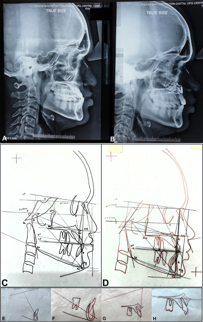 Revisiting the Anterior Maxillary Subapical Osteotomy and Advancement ...