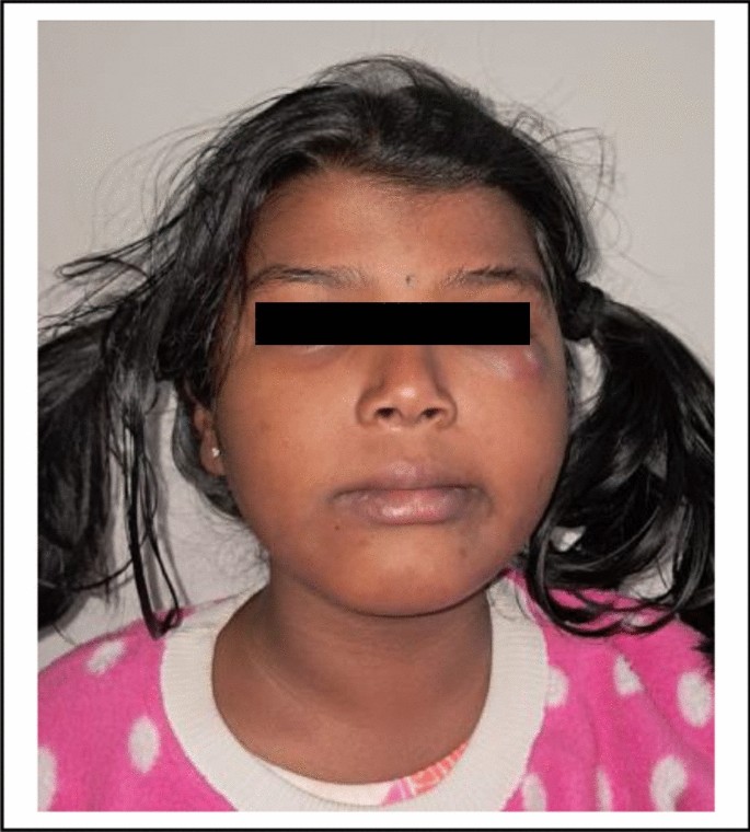 Navigating the Diagnostic Labyrinth of Scrofuloderma Orbit in ...