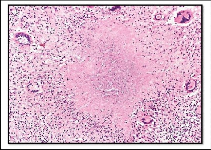 Navigating the Diagnostic Labyrinth of Scrofuloderma Orbit in ...