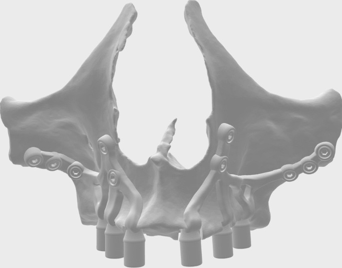 Prevention of Subperiosteal Implant Complications with a Novel ...