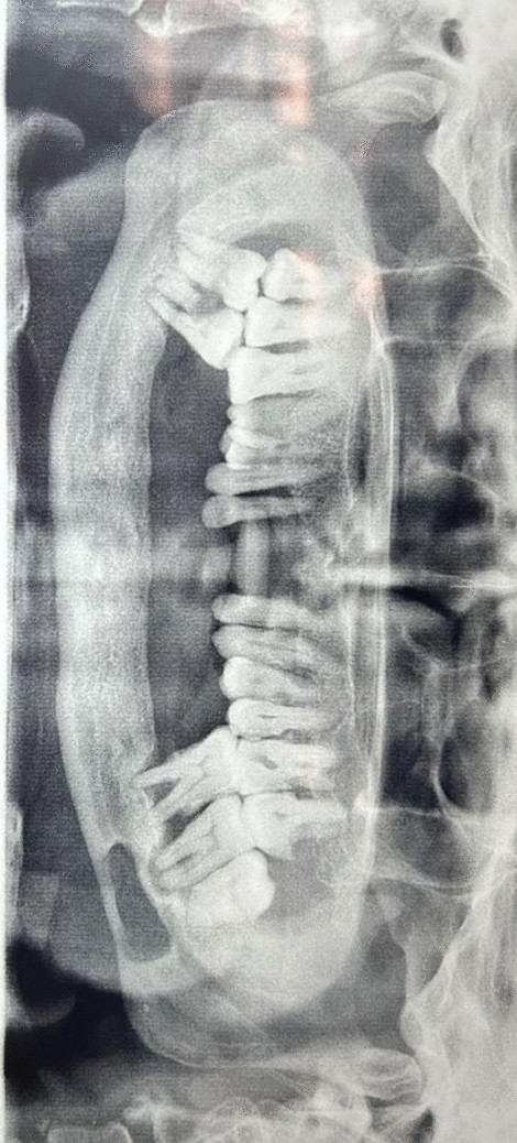 Reticent Stafne’s Bone Defect: An Incidental Finding | Journal of ...