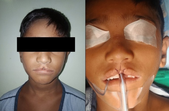 Trifid Epiglottis with Midline Cleft Lip: A Rare Craniofacial Anomaly ...