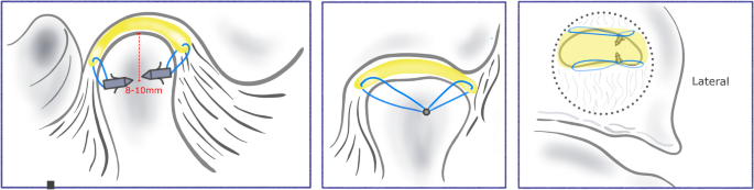 Temporomandibular Joint Disc Replacement with Acellular Dermal Matrix ...