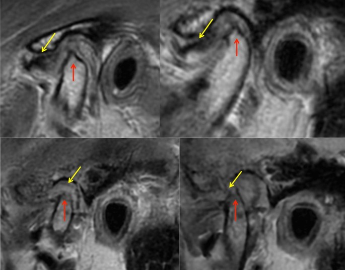 Temporomandibular Joint Disc Replacement with Acellular Dermal Matrix ...