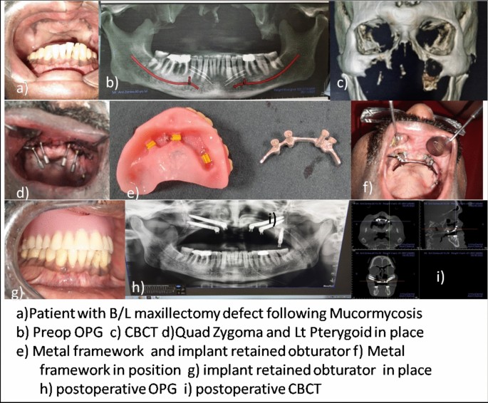Rehabilitation of Maxillectomy Patients Using Zygoma Implants | Journal ...