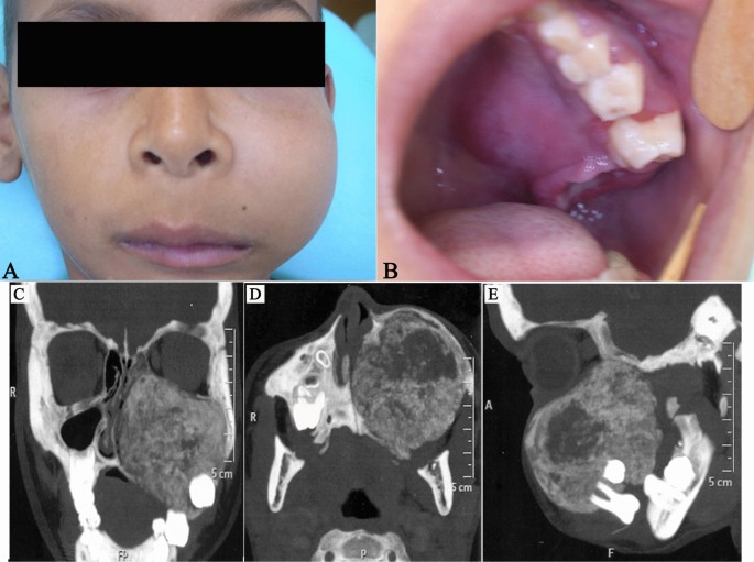 Maxillary Mesenchymal Chondrosarcoma Affecting A Pediatric Patient ...