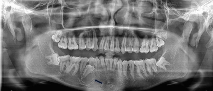 Primordial Odontogenic Tumor Associated with Impacted Supernumerary ...