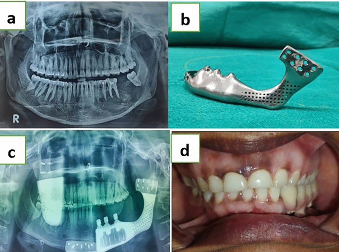 Patient-Specific Three-Dimensional Printed Titanium Implants for ...