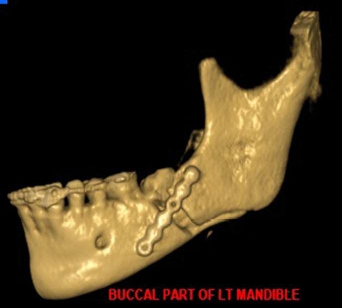 Dal Pont Versus Epker: Which Sagittal Split Osteotomy Technique is More ...